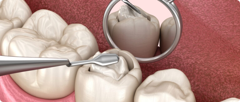 Composite esthétique stratifiée | Dentiste à Biarritz | Dr Le Gac